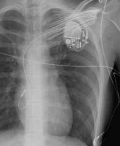 Leven met een Pacemaker of ICD - Hart in Shape