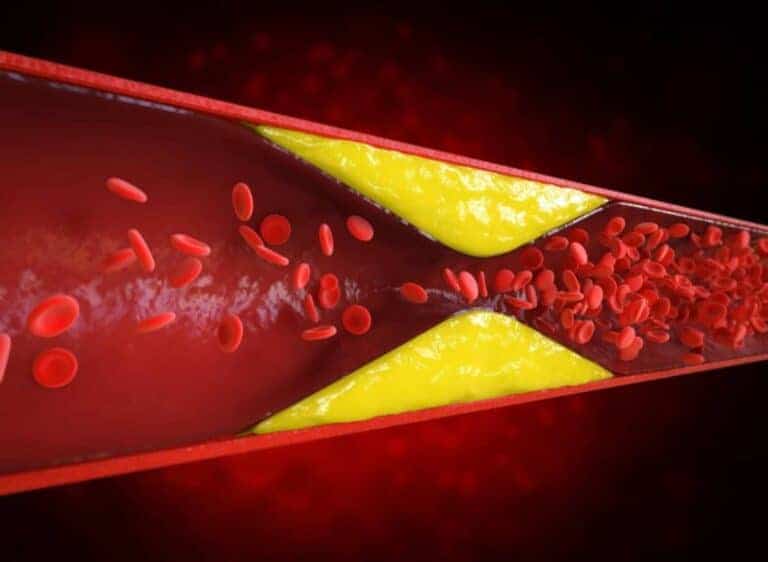 Wat is een kransslagader verkalking? - Hart in Shape